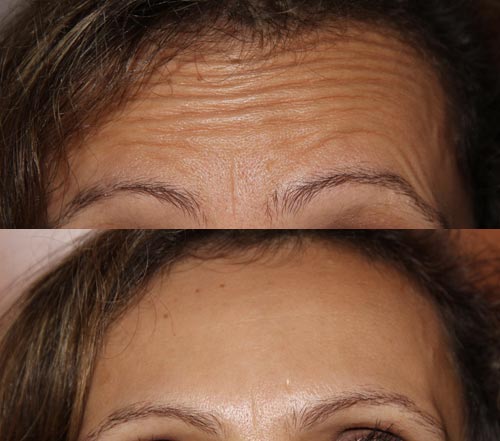 Botox